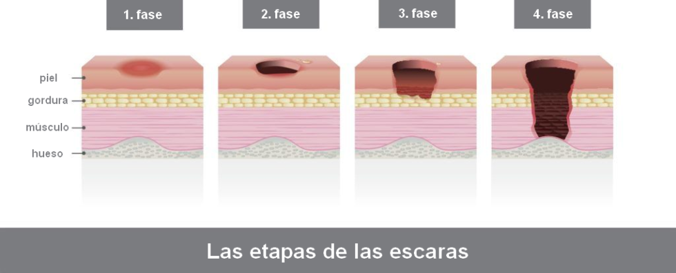 SOBRE LAS ESCARAS