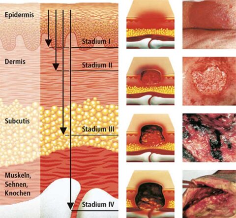 Dekubitusgrad | dermolex