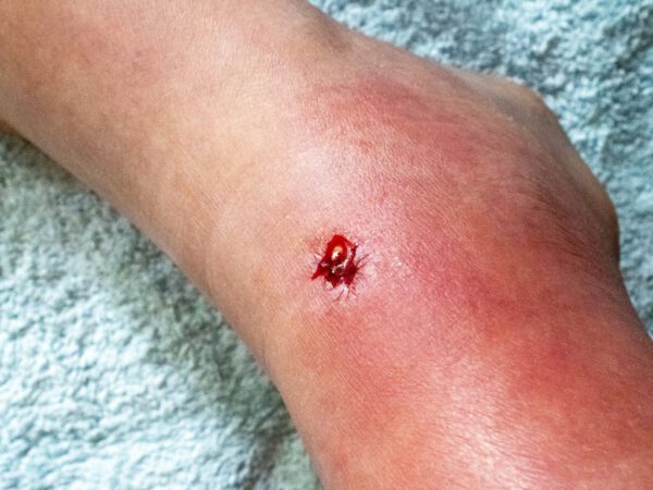 Infizierte Wunde – Erkennen und behandeln | dermolex